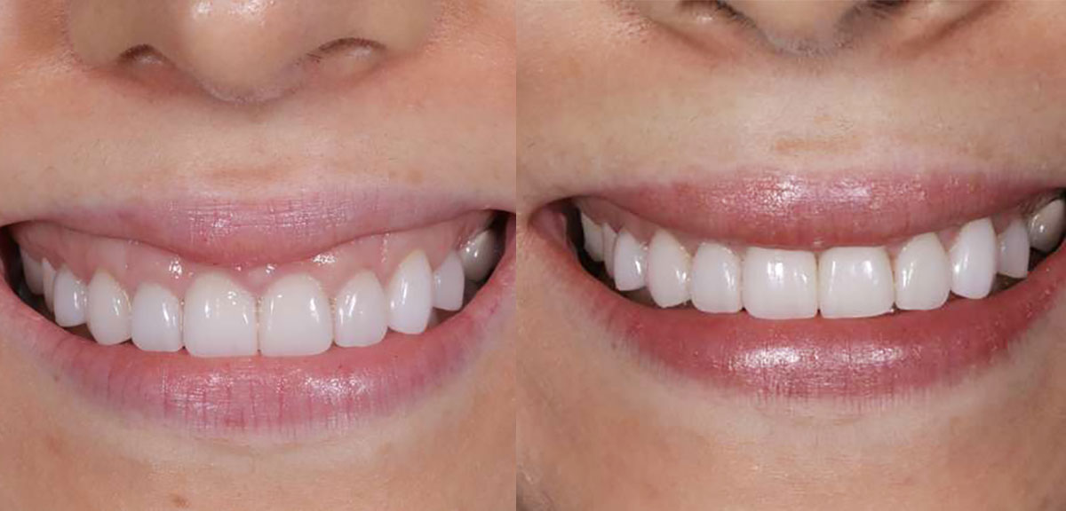 What You Need To Know About Treating Gummy Smile With Botox - IMPLANT ...
